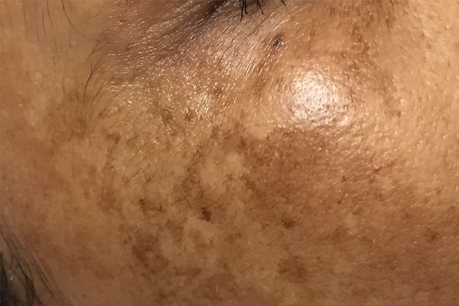 Best Treatments for Sun Damage & Skin Repair | Eden