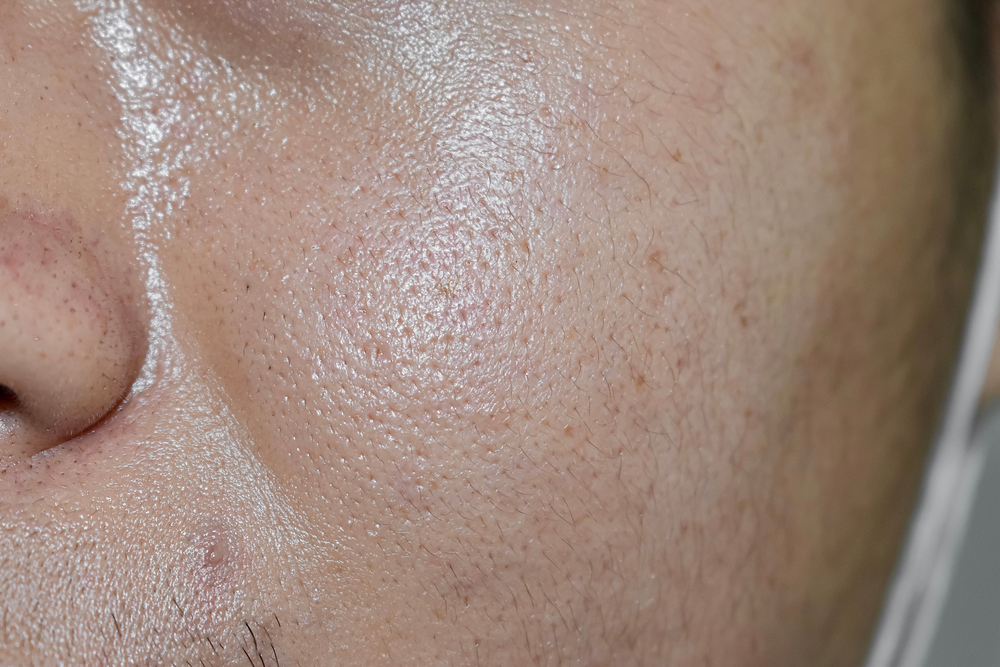 Oily Skin Treatments Wimbledon Kensington Skin Clinics