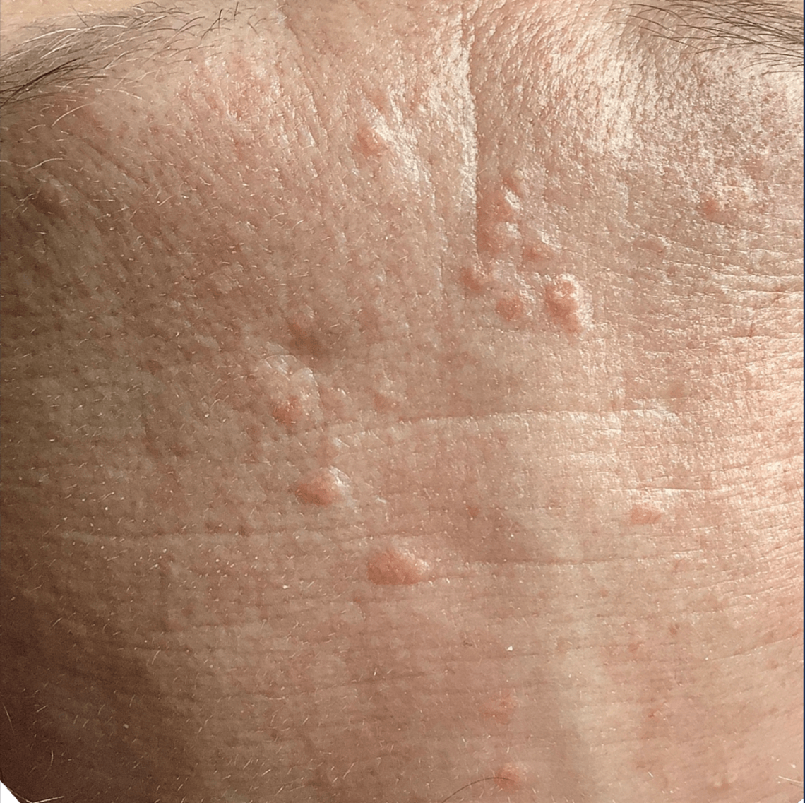Sebaceous Hyperplasia Treatments Wimbledon And Kensington