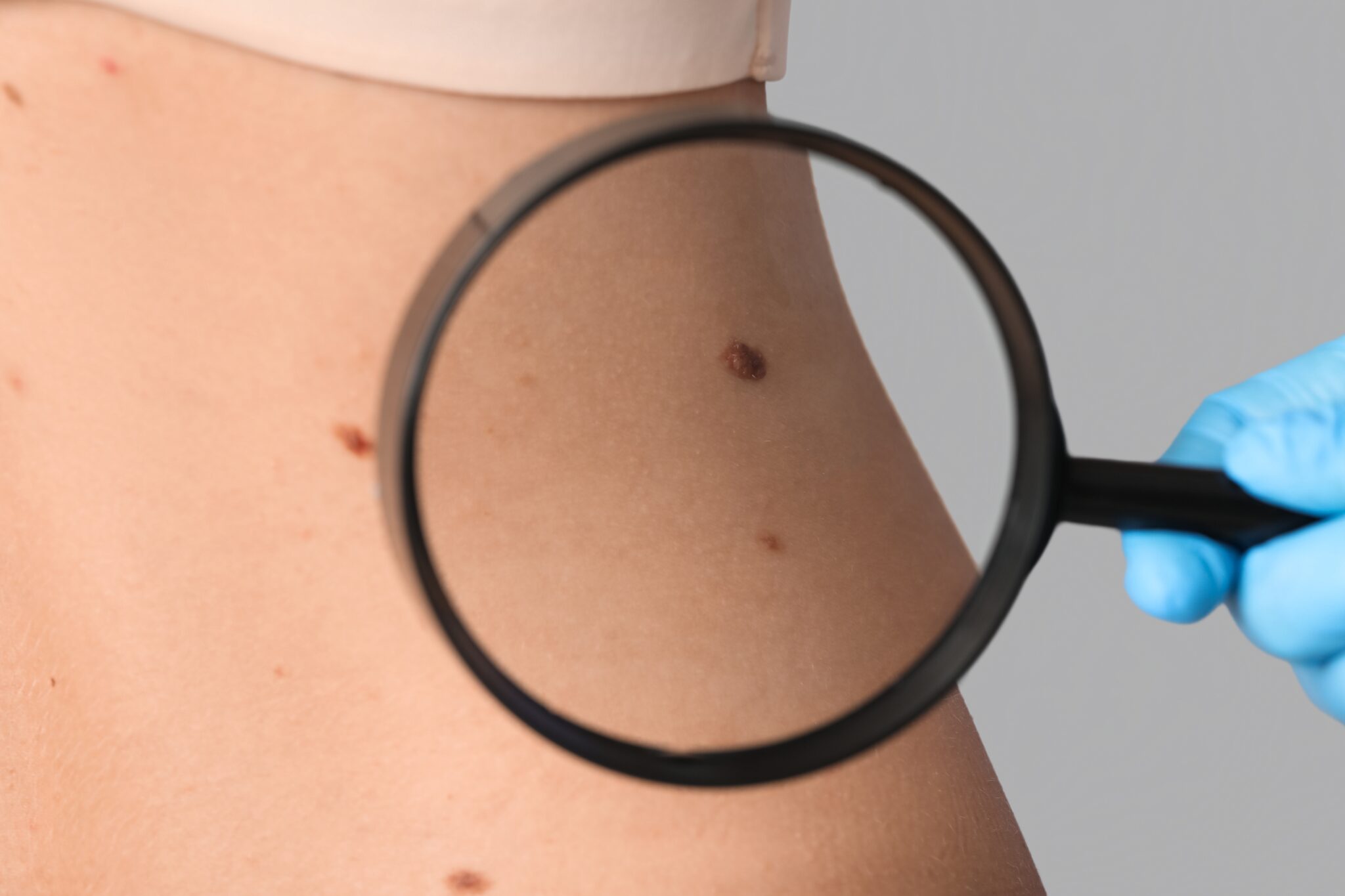 Why Mole Mapping Should Be Part of Your Skin Health Routine