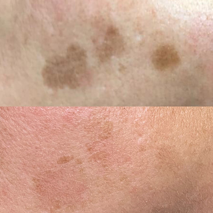 CryoPen Treatments Skin Clinic Kensington & Wimbledon London