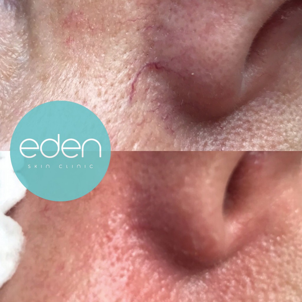 IPL Red Thread Vein Treatments Wimbledon & Kensington London